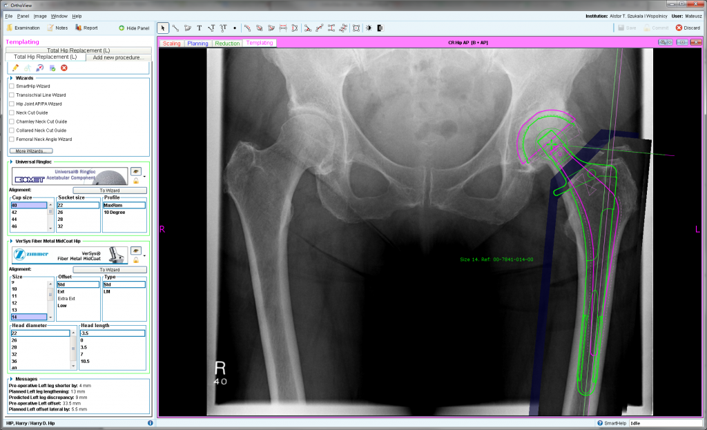 OrthoView - oprogramowanie do przedoperacyjnego planowania implantacji ...